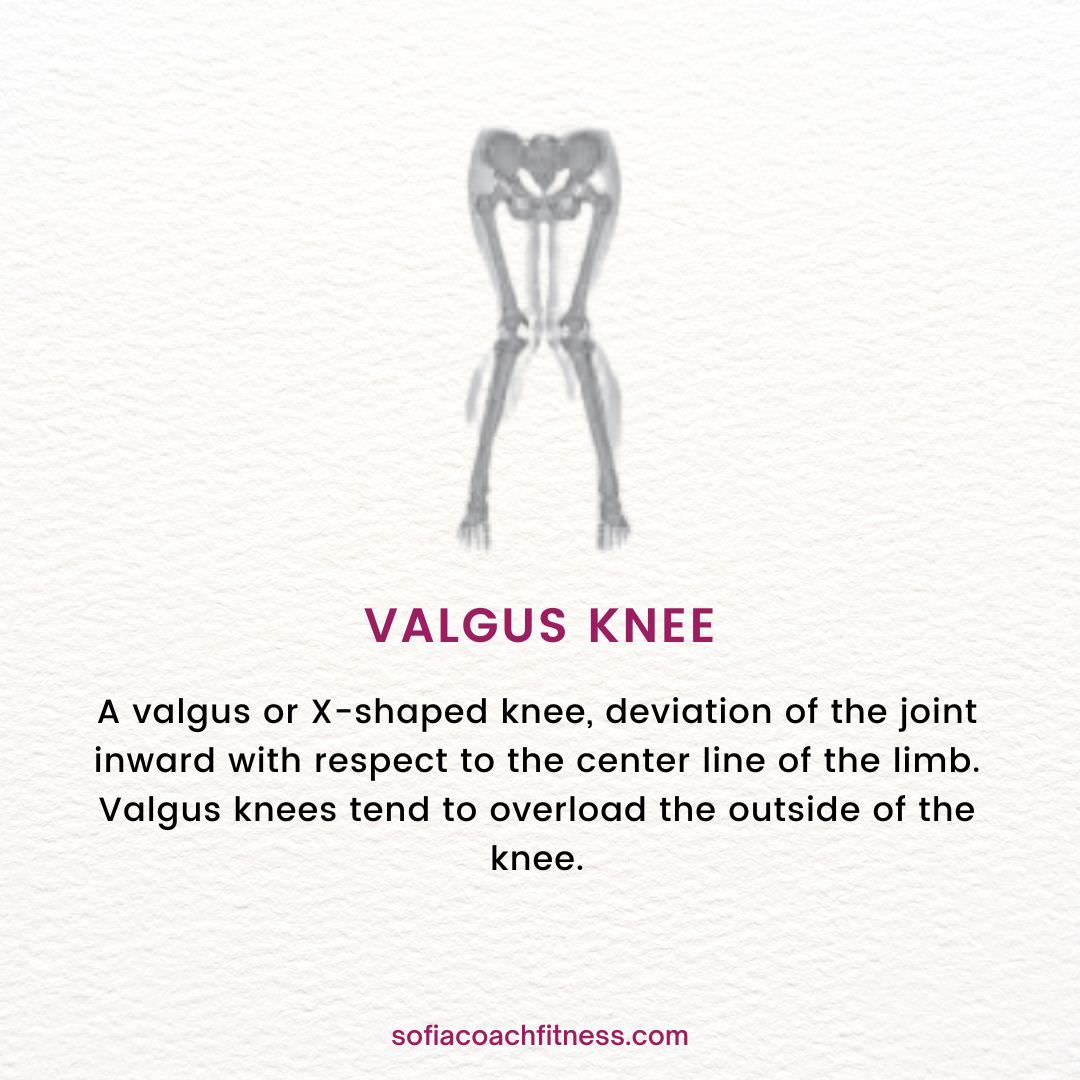 Valgus and Varus Knees