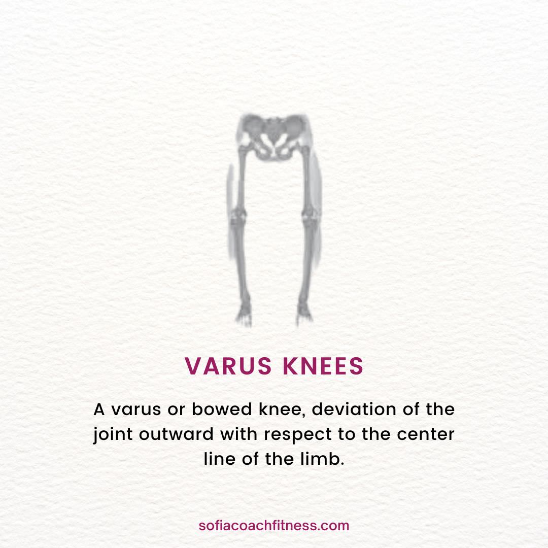 Valgus and Varus Knees